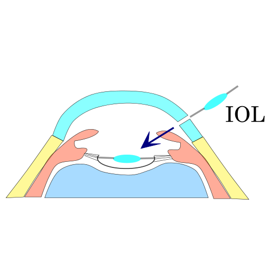 iol – MedCon